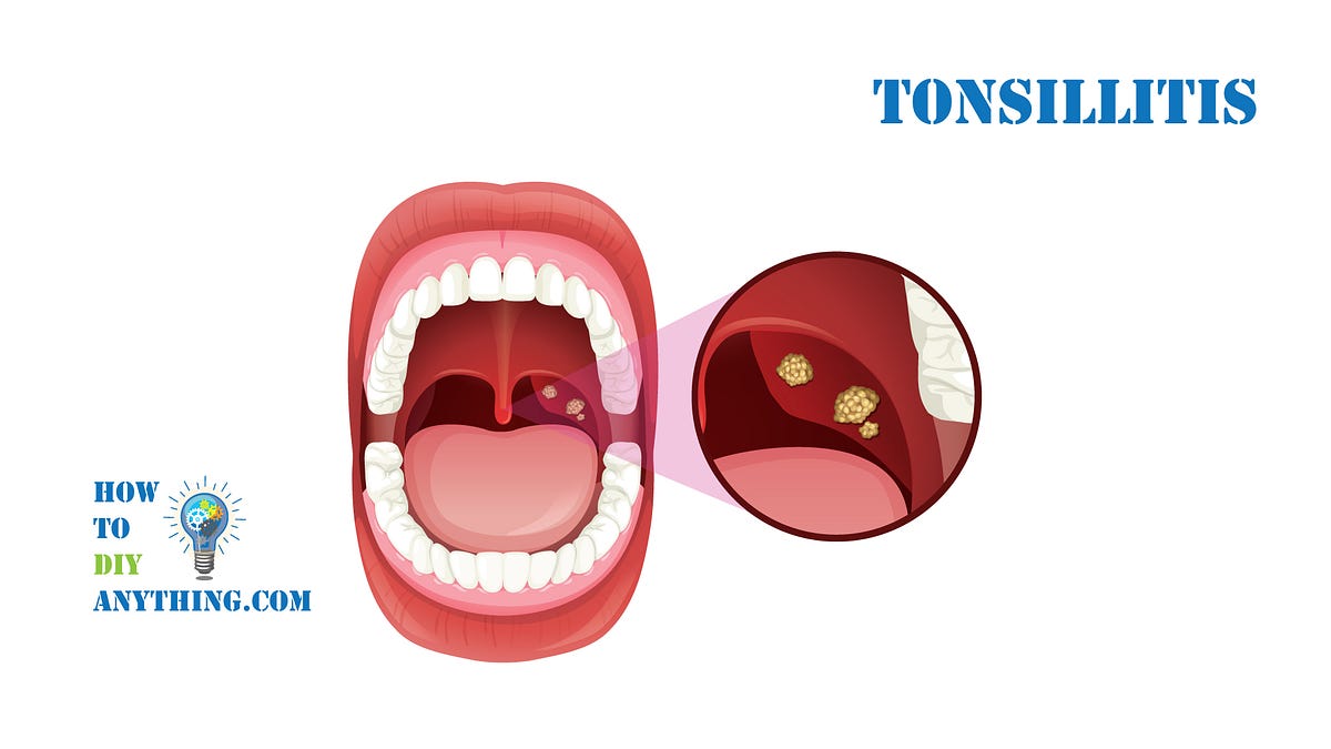 Tonsillitis — How To Get Rid Of Them? Ultimate Easy Guide — 2021 ...