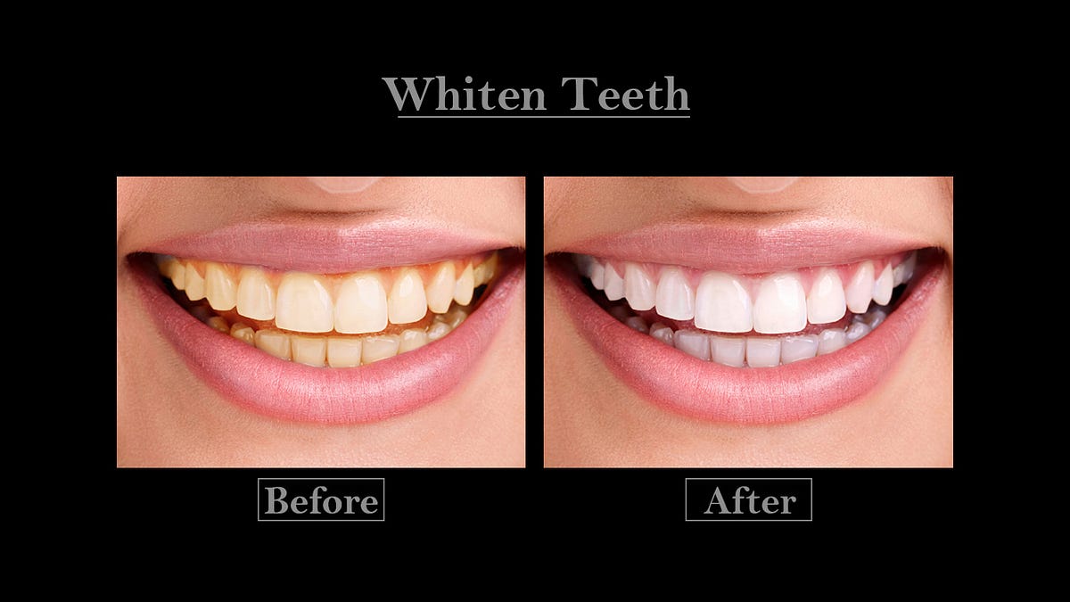 Whiten Teeth. Professional Photo Editing Service | by Photo Editing ...