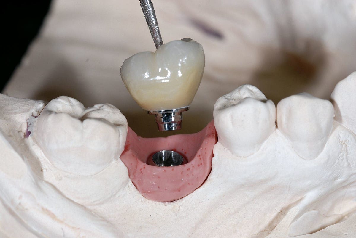 Confident Smiles, Securely Attached | Screw Retained Dental Implants ...