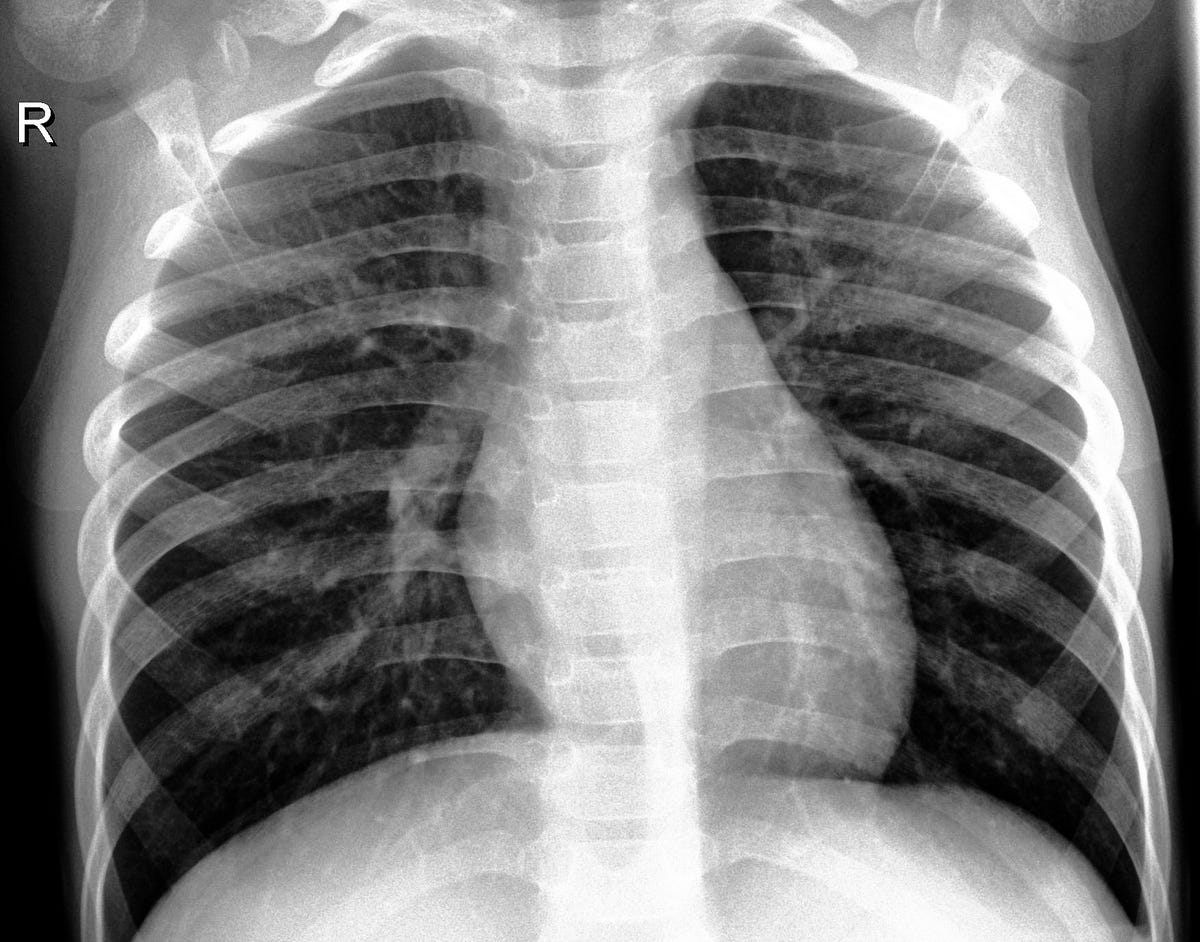 Detecting COVID-19 infection using Chest X-rays | by Navendu Pottekkat ...