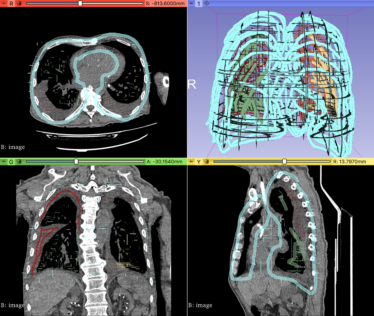 Radiologists’ nightmare — segmentation masks | by Paulina Tomaszewska ...