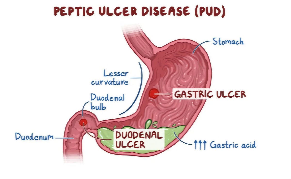 "Management of Perforated Peptic Ulcer" | by Reza Lankarani | Feb, 2025 ...