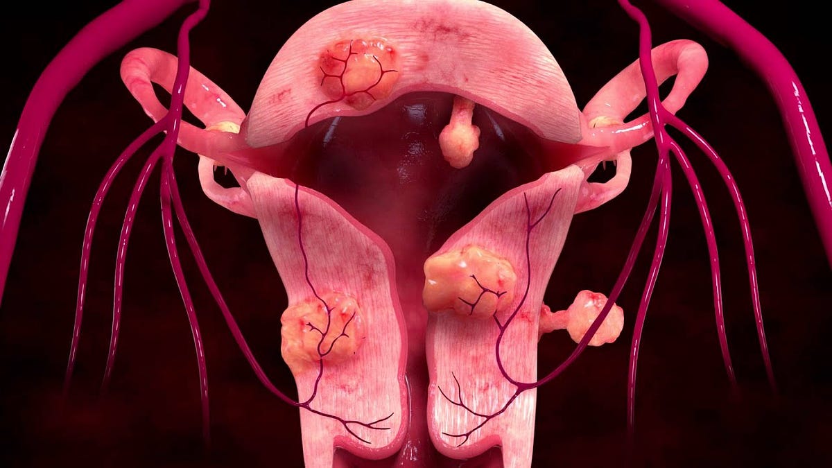 What is Uterine Artery Embolization? - Hill Regional Hospital - Medium