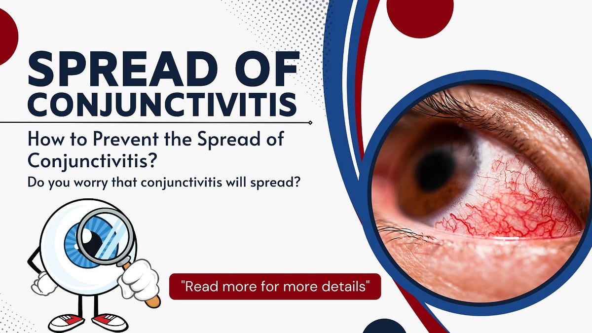 HOW TO PREVENT THE SPREAD OF CONJUNCTIVITIS: TIPS FROM THE BEST EYE ...