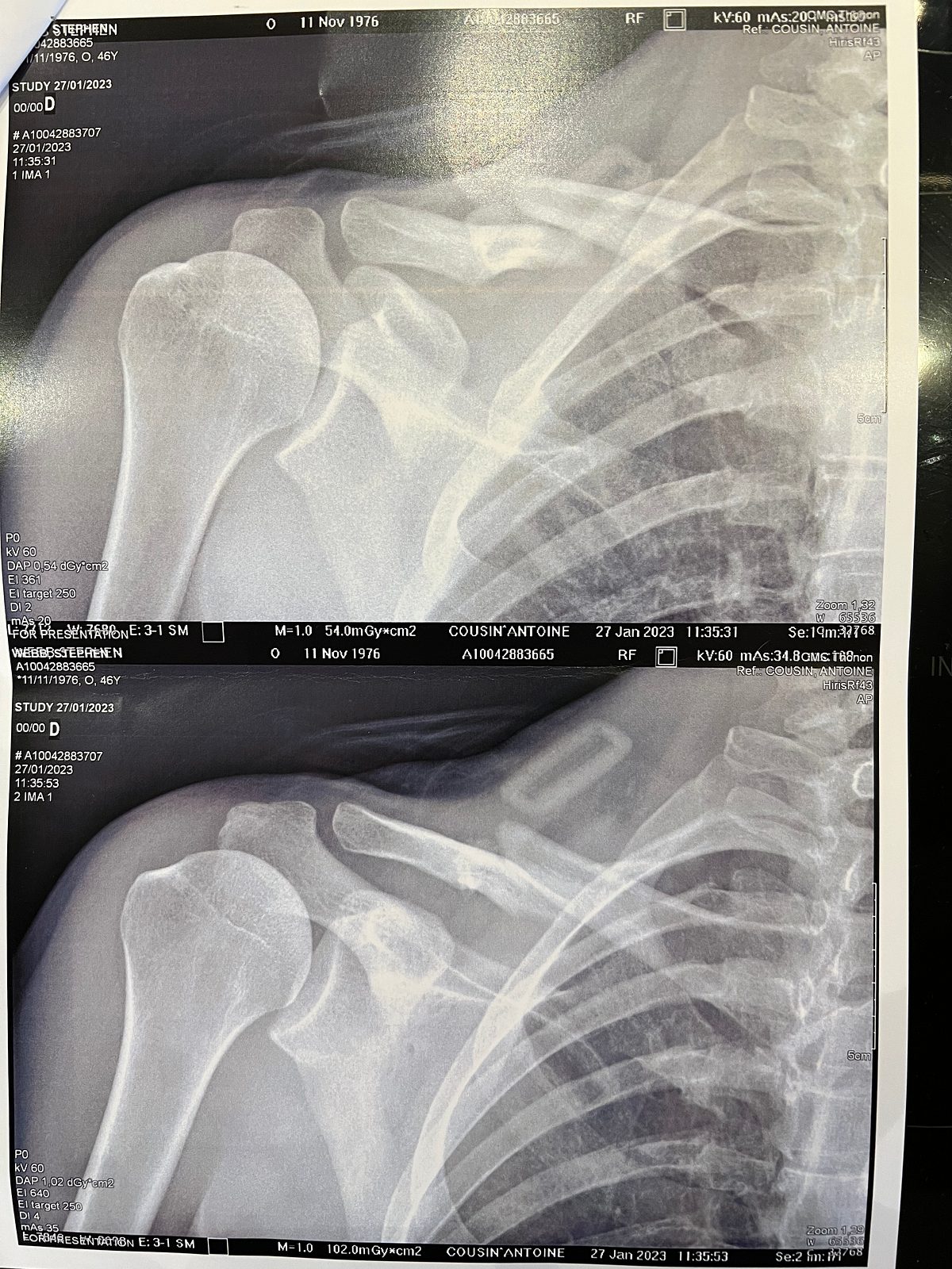Recovering from a broken collarbone | by Gray Webb | Medium