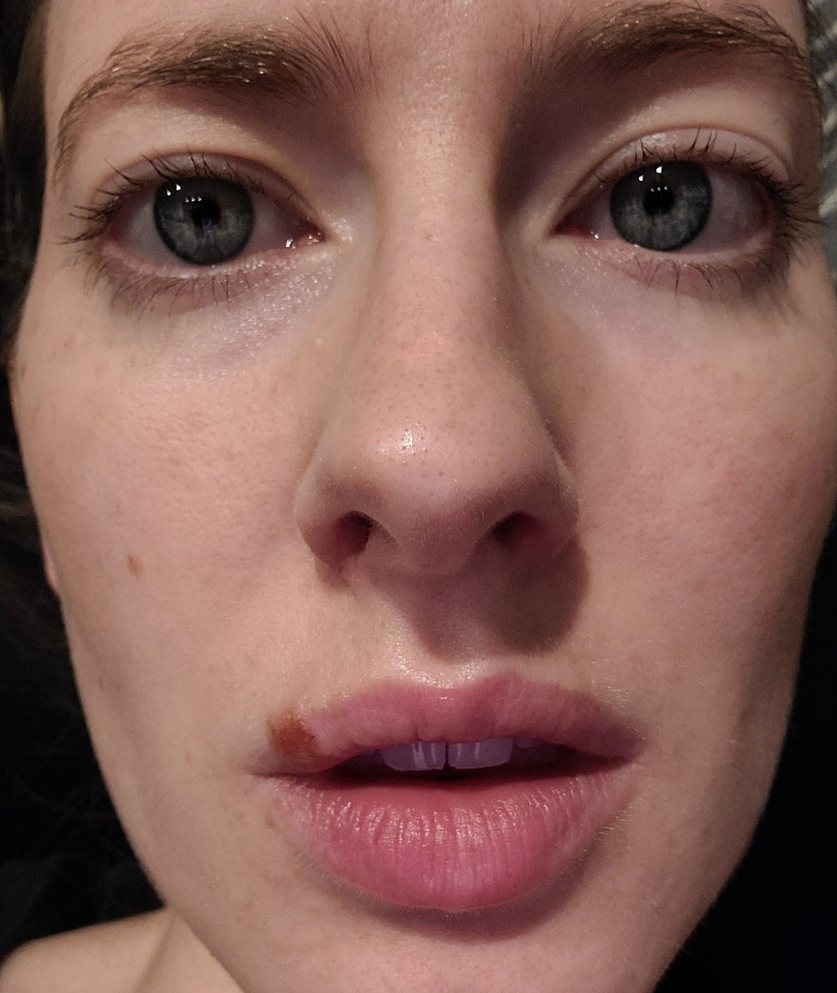 Stop Cold Sores in Their Tracks: Causes and Healing Tips | by Danielle ...