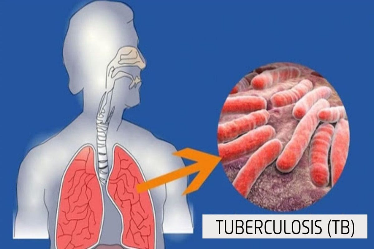 Tuberculosis- 4 types of TB. Are you suffering fromy TB? | by Sarita ...