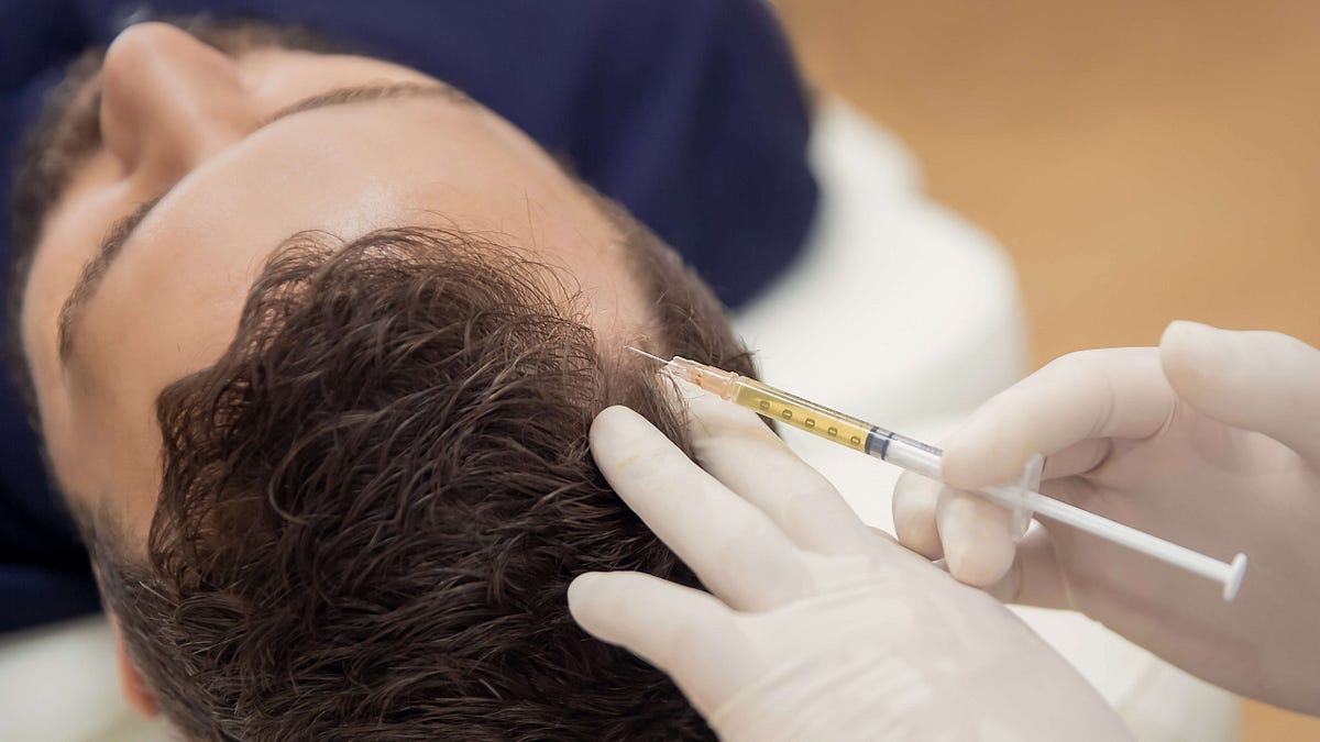 Turning Back the Clock: PRP for Hair Loss | by Support | Medium