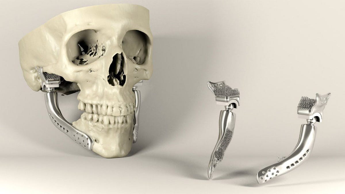 Beyond Borders: The Global 3D Printed Maxillofacial Implants Market ...