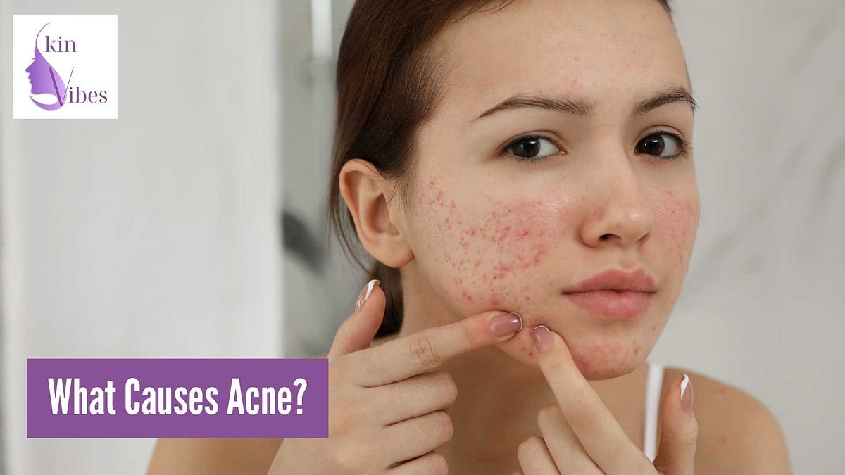 What Causes Acne. Acne is a common skin condition that… | by Skin Vibes ...