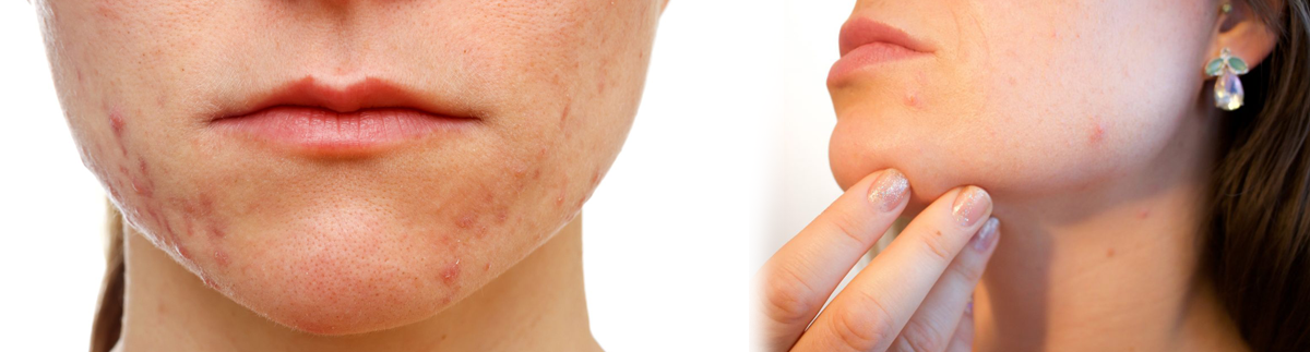 8 critical facts to keep in mind about Laser Treatment for Acne Scars ...