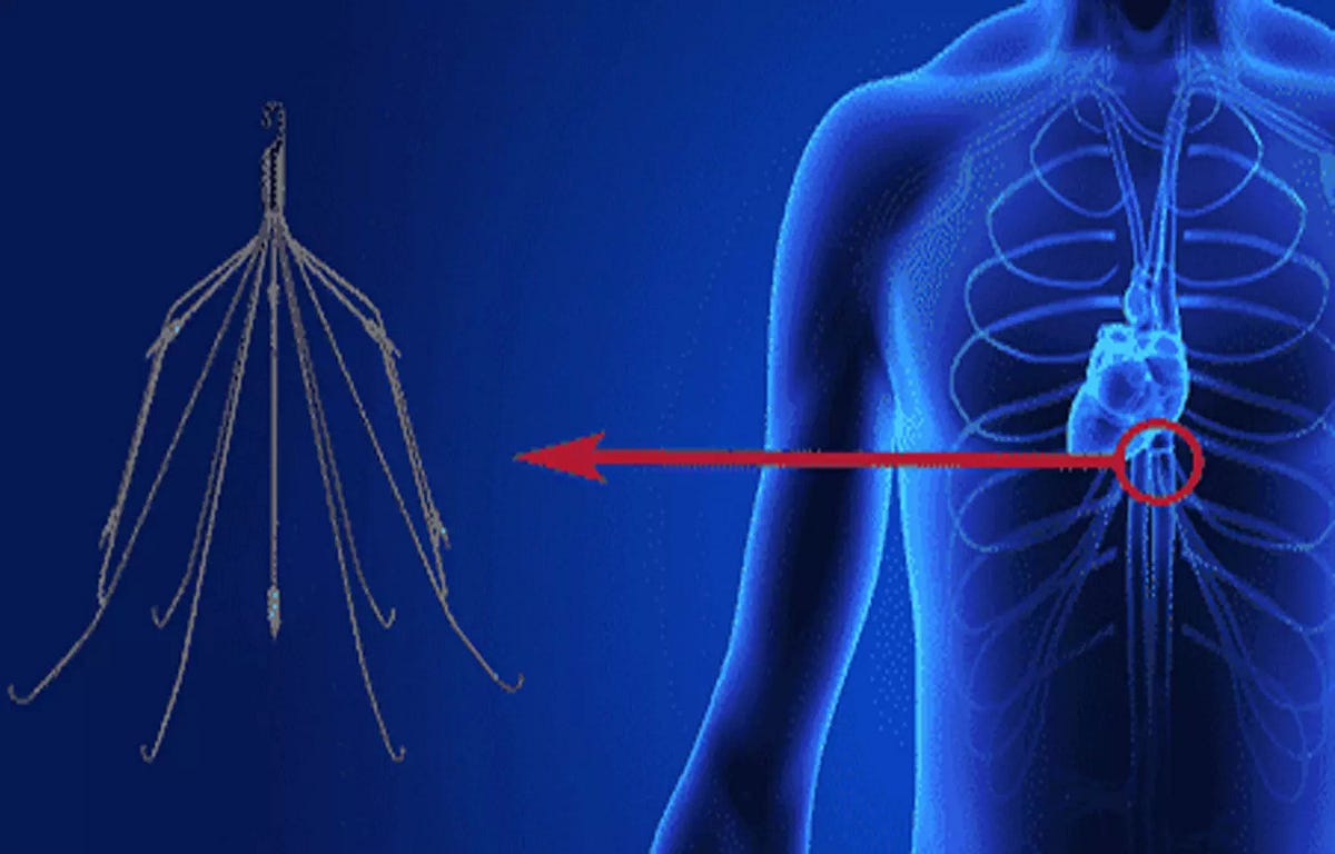 Inferior Vena Cava (IVC) Filters Market Overview, Region/country, Size ...