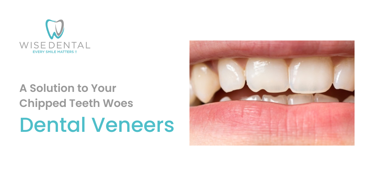 A Solution to Your Chipped Teeth Woes: Dental Veneers | by Wise Dental ...