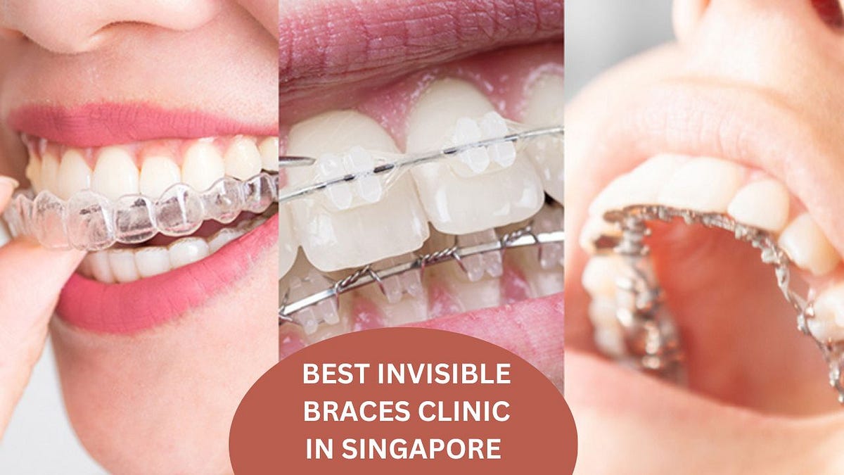 The 5 Best Invisible Braces Brands – SIKY