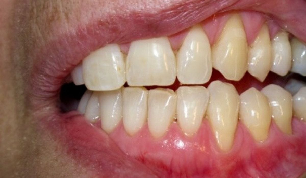 If Your Gums Are This Damaged, Your Teeth Will Fall Out-Decayed In A ...