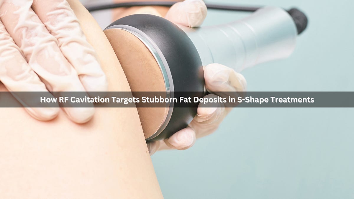 How RF Cavitation Targets Stubborn Fat Deposits in S-Shape Treatments | by myChway | May, 2024 ...