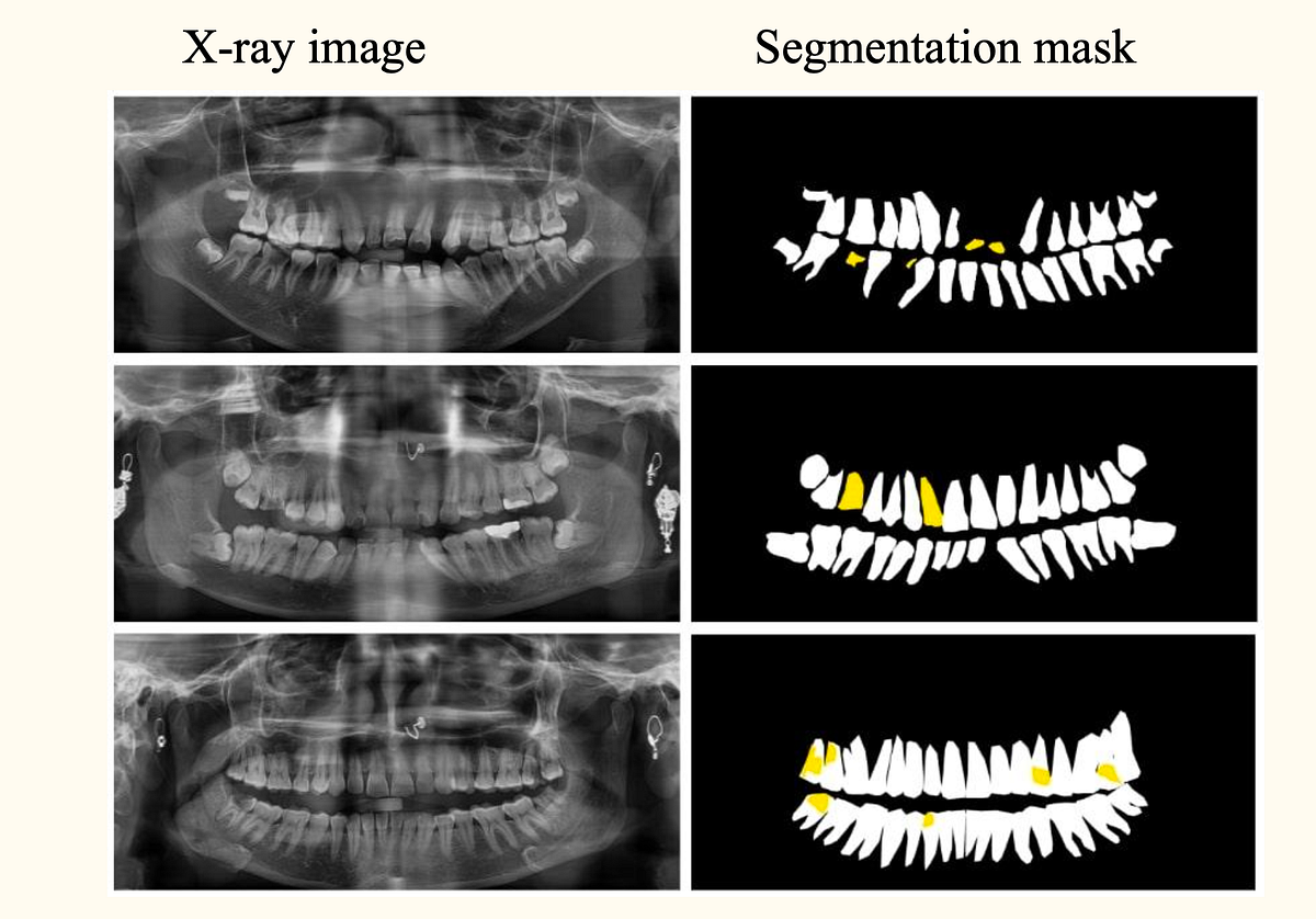 🦷 Automating Dental Caries Detection With Deep Learning A U Net Based Approach By
