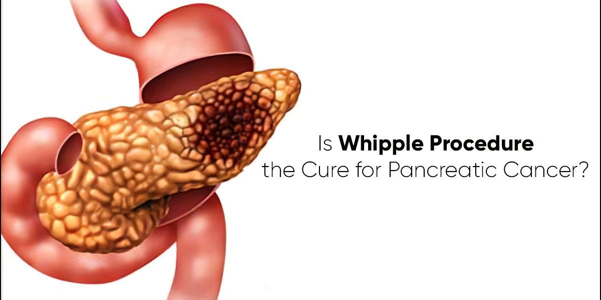IS WHIPPLE PROCEDURE THE CURE FOR PANCREATIC CANCER? - Dr. Mark D ...