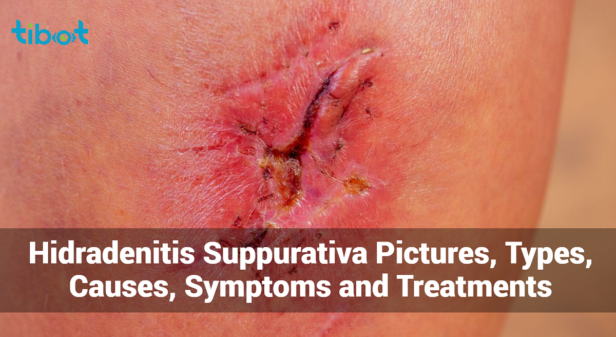 Hidradenitis Suppurativa: Pictures, Types, Causes, & Treatments | by Eczemaless | May, 2024 | Medium