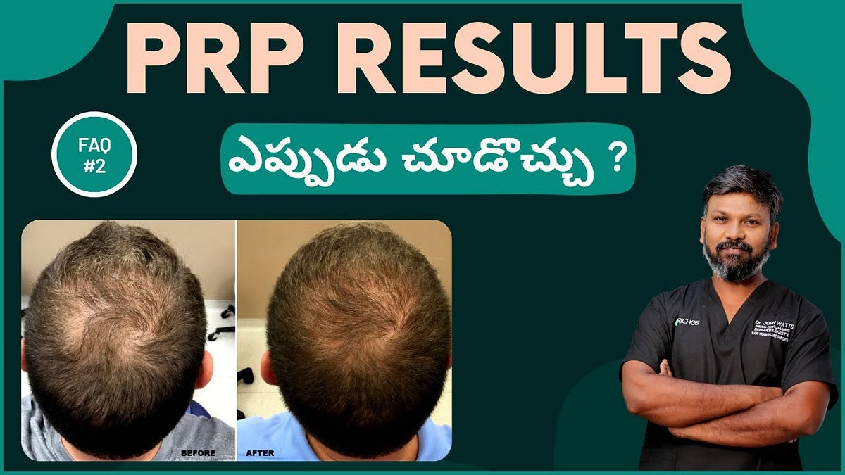 How many PRP sessions are needed for optimal hair growth results ...