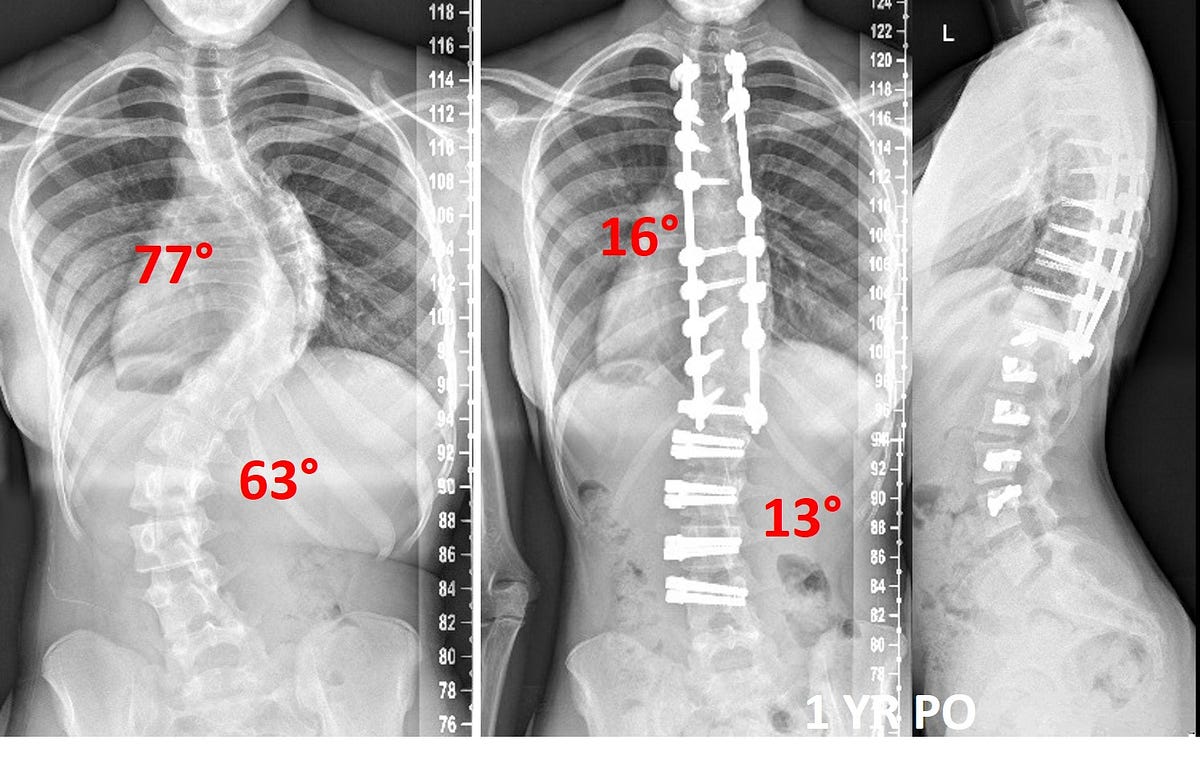 What to Know About Scoliosis Surgery for Adults | by Adam Vital ...