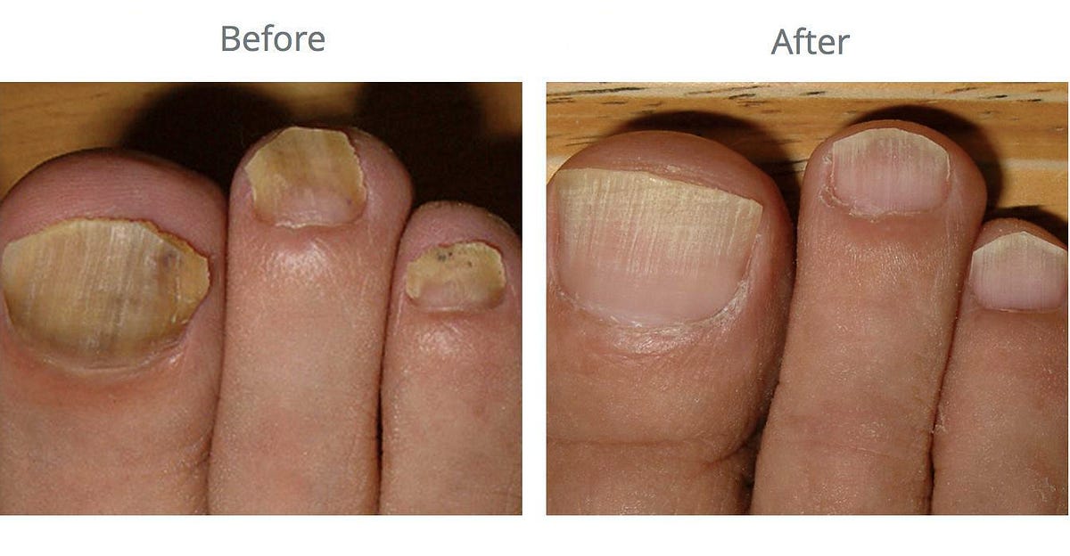 Toenail Fungus as a Potential Indicator of Underlying Medical ...