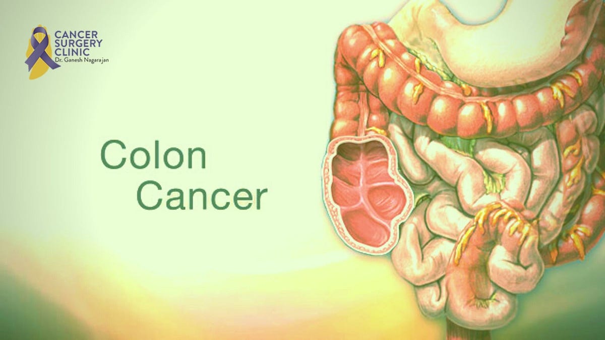 Colorectal Cancer Treatment By Surgery in Mumbai - Dr. Ganesh Nagarajan ...
