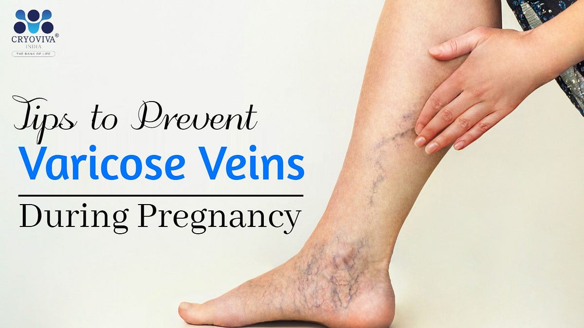 Tips to Prevent Varicose Veins During Pregnancy | by Avani Singh | Feb ...