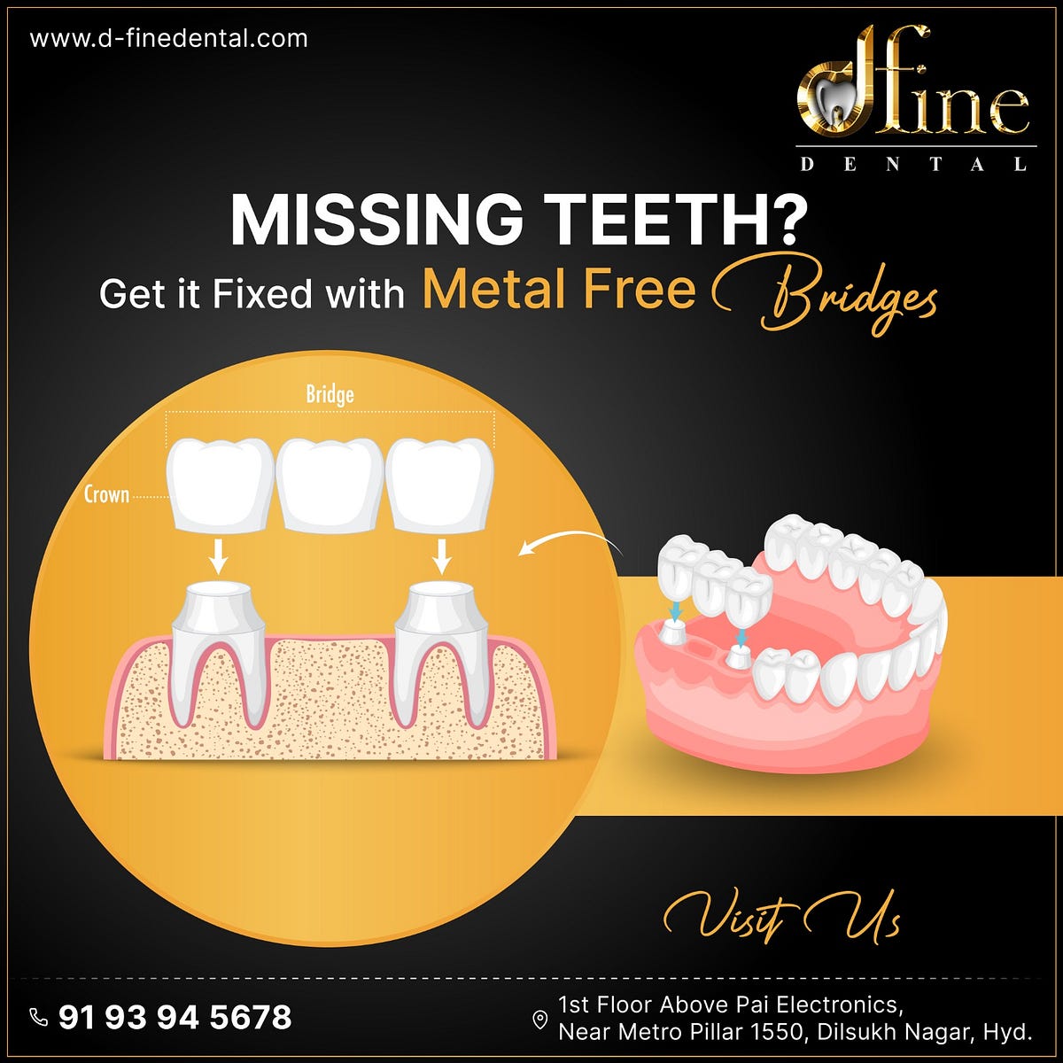 Fixed Teeth in a Day Treatment in Dilsukhnagar | by Dfine Dental Clinic ...