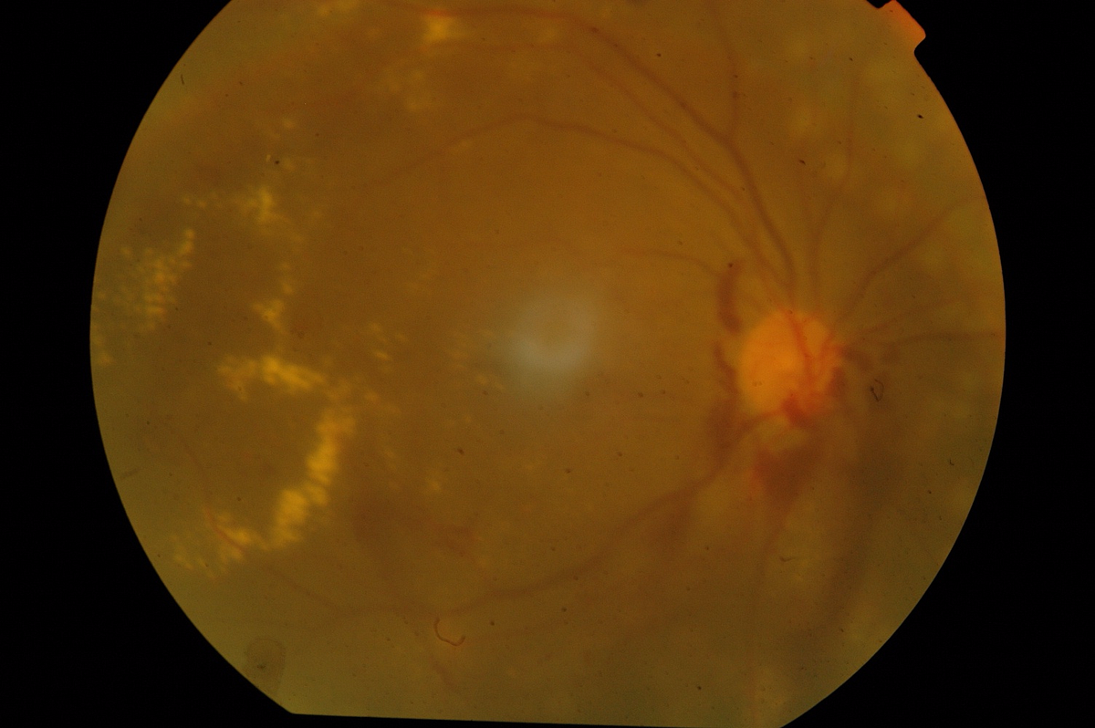 AI in Healthcare: A Deep Dive into Detecting Diabetic Retinopathy | by ...