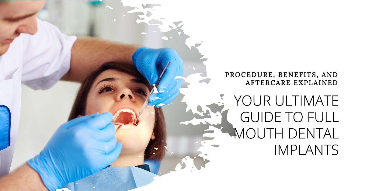 The Complete Guide to Full Mouth Dental Implants: Procedure, Benefits ...