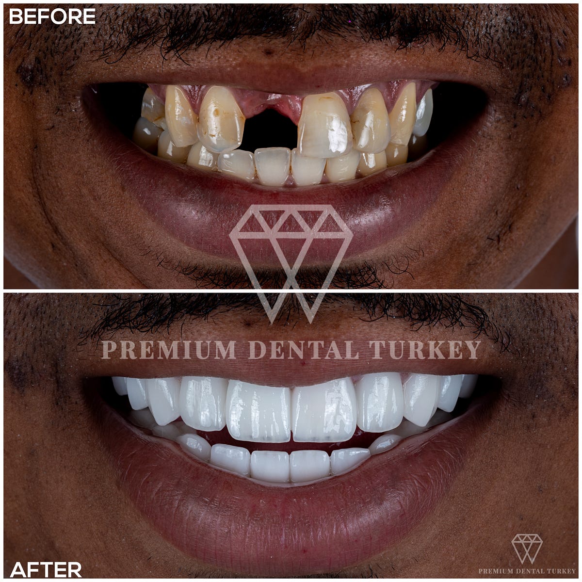 Turkey Teeth Prices. A radiant smile not only enhances our… | by ...