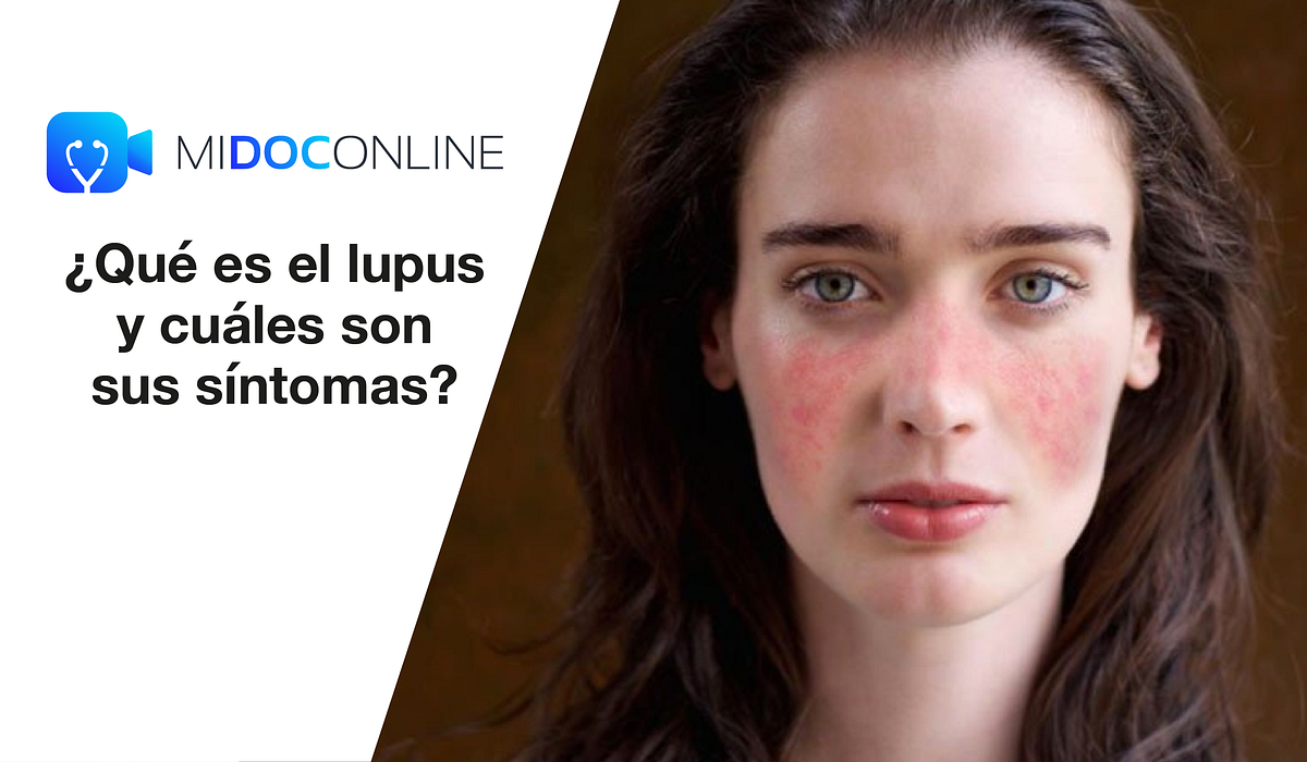 ¿Qué es el lupus y cuáles son sus síntomas? | by MIDOCONLINE | Medium
