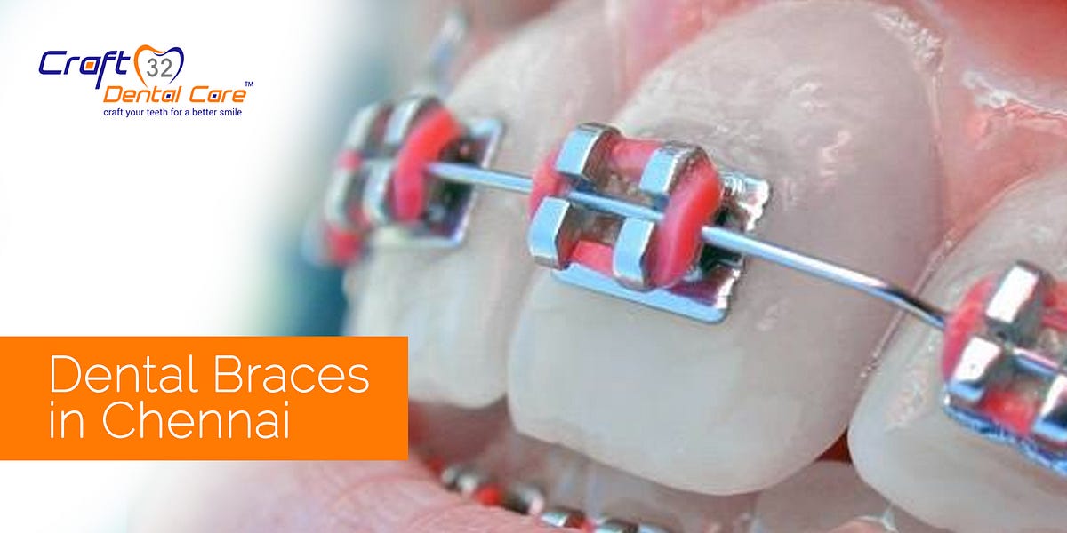 Dental Braces in Chennai. Craft Dental Care offers the first-rate… | by ...
