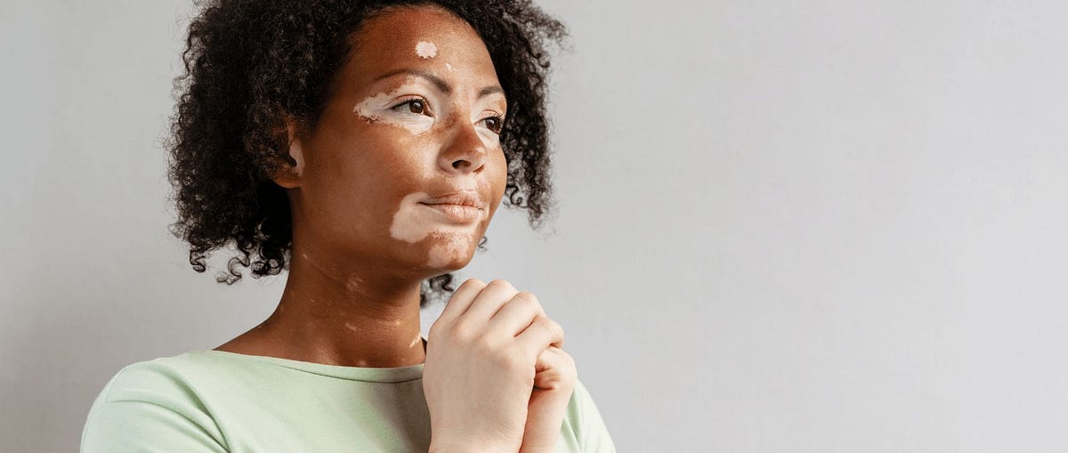Safed Daag Ka Ayurvedic Ilaaj Ayurveda The Traditional System Of By Vitiligo Care Medium