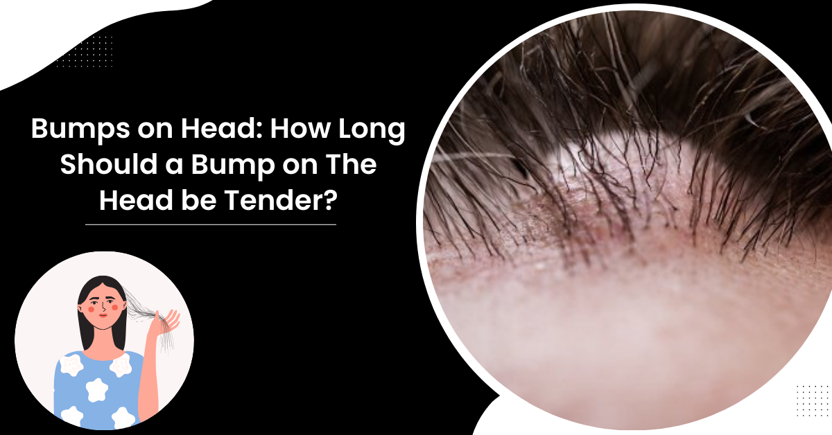 Bumps On Head How Long Should A Bump On The Head Be Tender By James Potter May 2024 Medium
