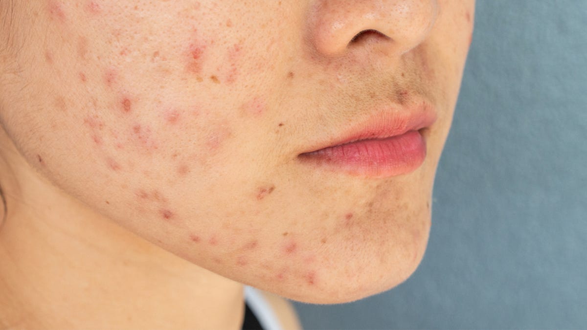 HOW TO DEAL WITH PERIOD ACNE. Something that most women can relate to ...