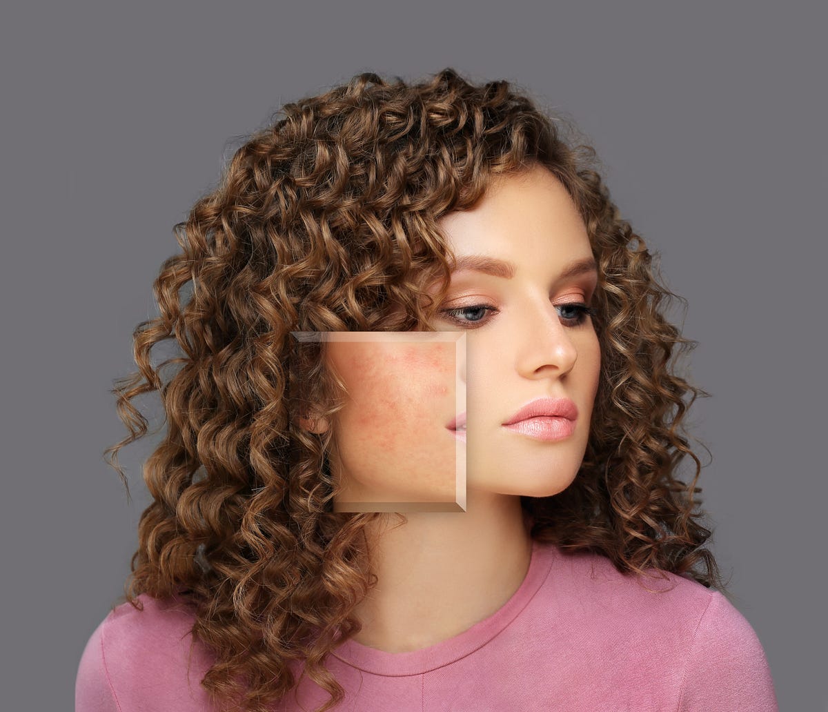 Decoding Rosacea: Could Your Red, Flushed Skin Signal Something More ...