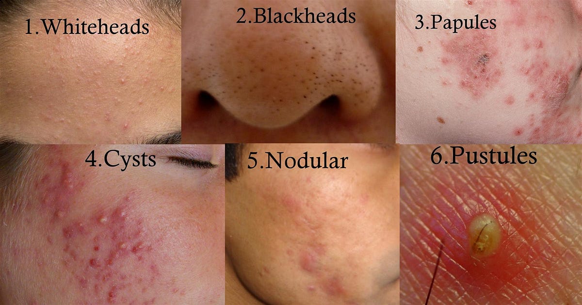 Cyst And Zit Popping — Learn The Facts Before Making Big Popping ...