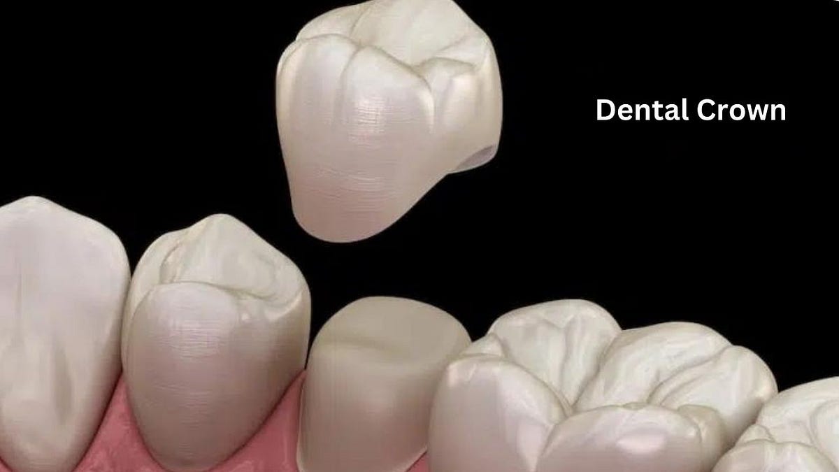 When do you need a dental crown? | Tooth Crown Bukit Timah — Garden ...