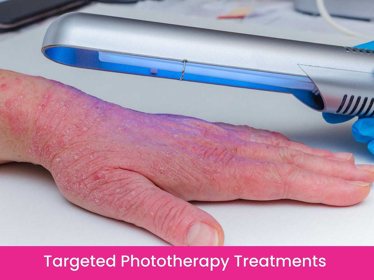 Targeted Phototherapy Treatments in Vadodara | by Aumvitiligoclinic ...