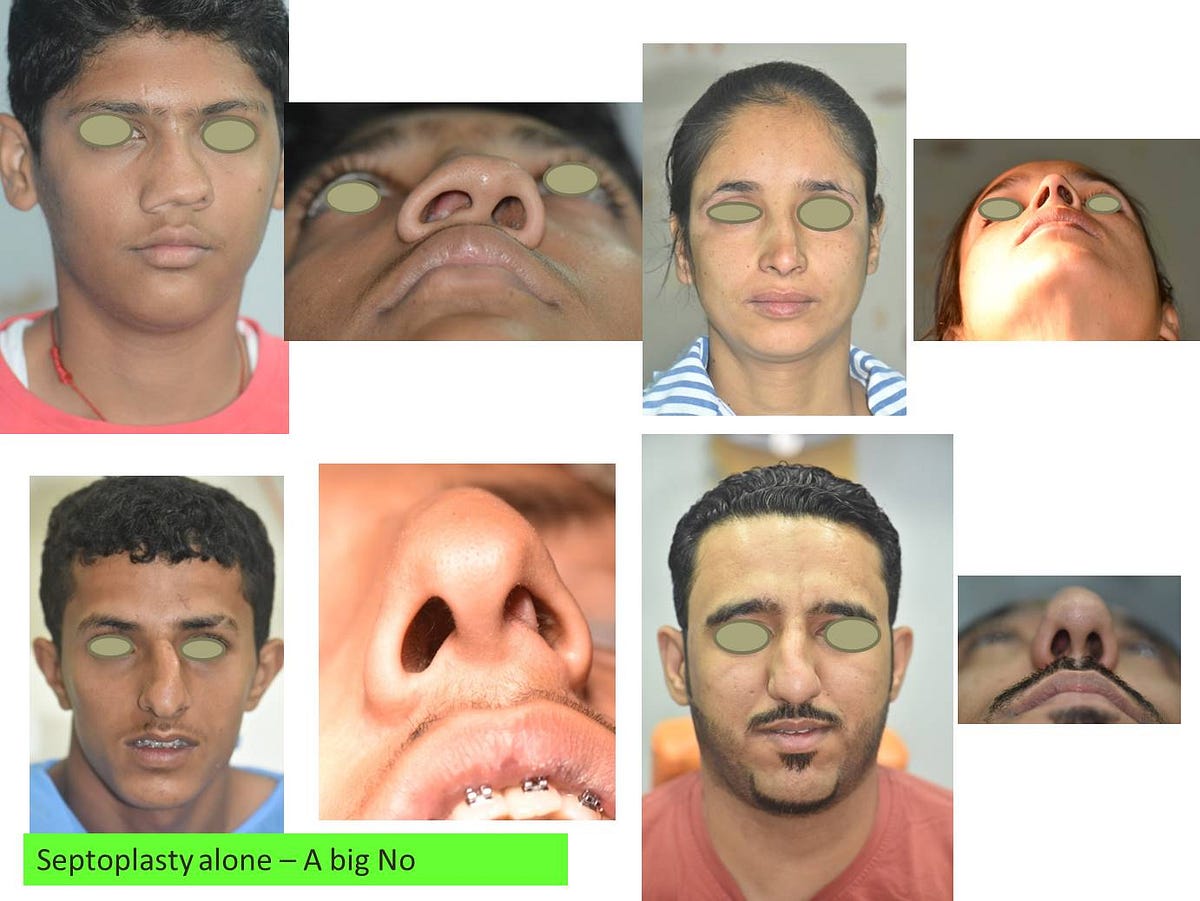 Crooked nose and deviated nasal septum | by Dr. Brajendra Baser | Medium