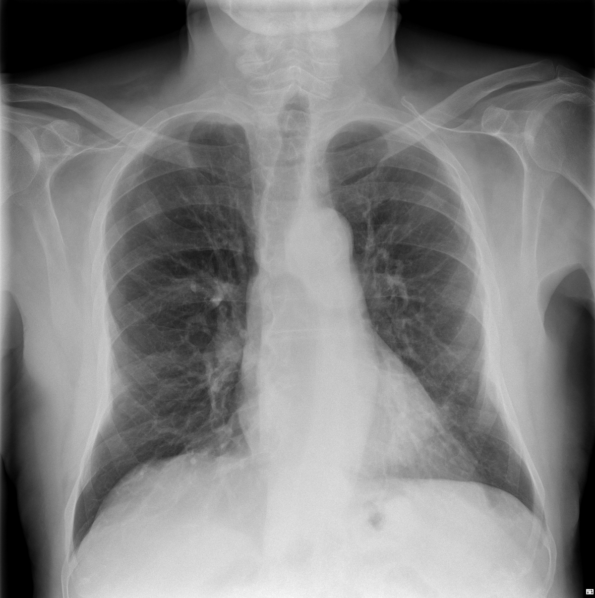 AI for Early Lung Cancer Detection - Building Trustworthy Multimodal ...