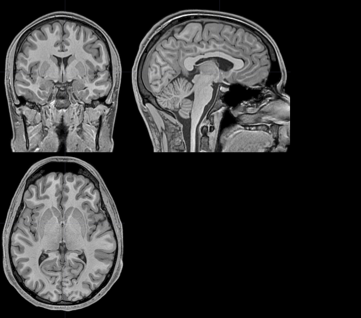 How to use FSL brain extraction. One of the most common tools in brain ...