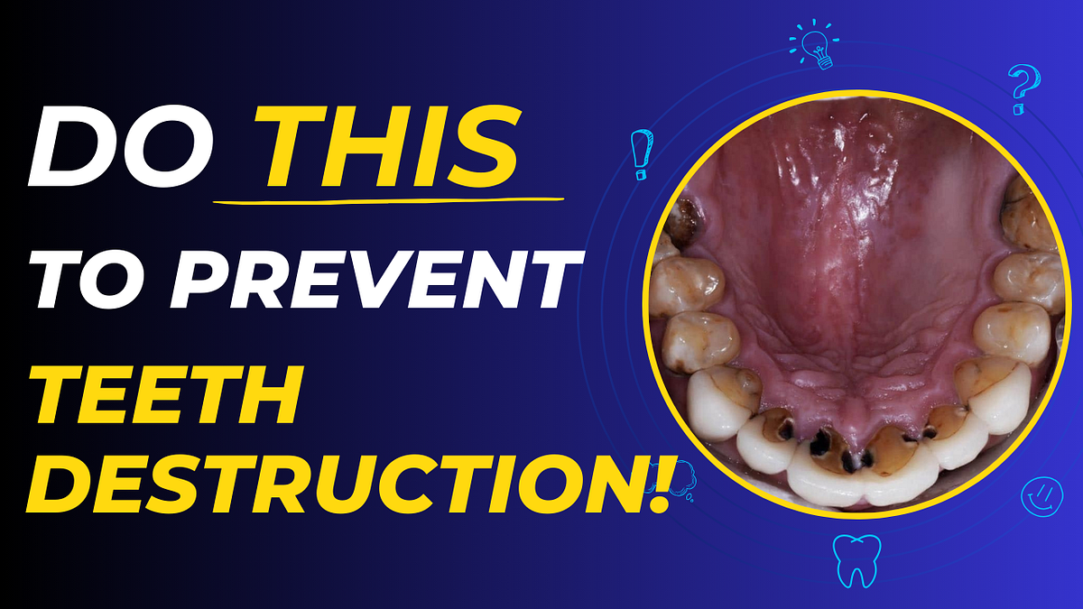 Root Canal: Saving Your Smile and Relieving Tooth Pain | by Pearly ...