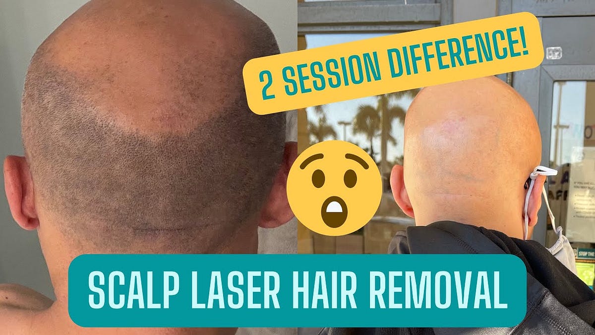 Laser Hair Removal In Abu Dhabi A Comprehensive Guide By Shedi Mar 2024 Medium