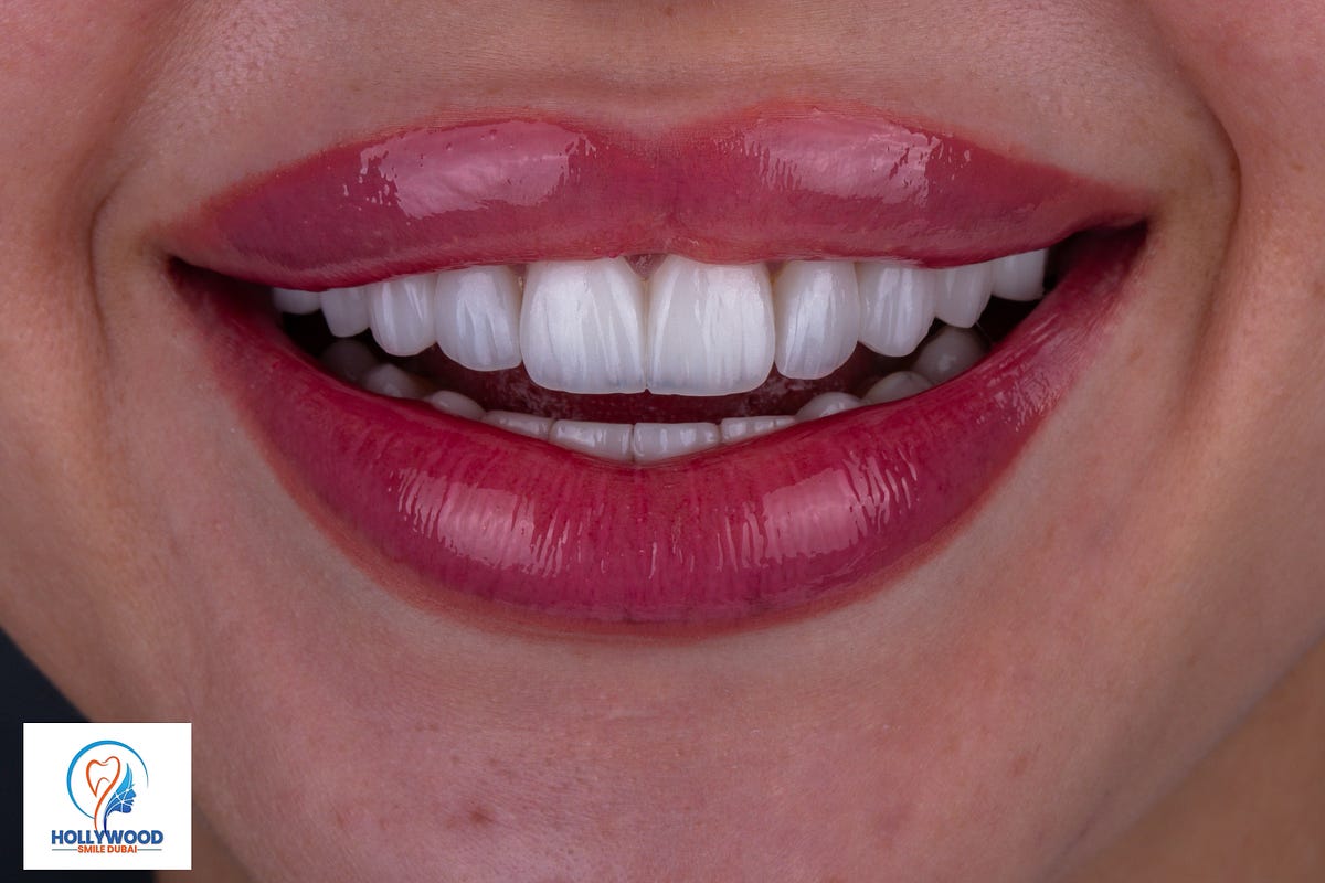 Hollywood Smile Porcelain Veneers, Lumineers - Hollywood Smile - Medium
