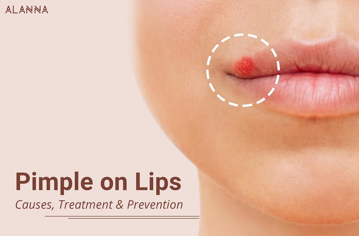 Pimple On Lips Causes Treatment And Prevention Alanna Indias First Specialised Lip Care