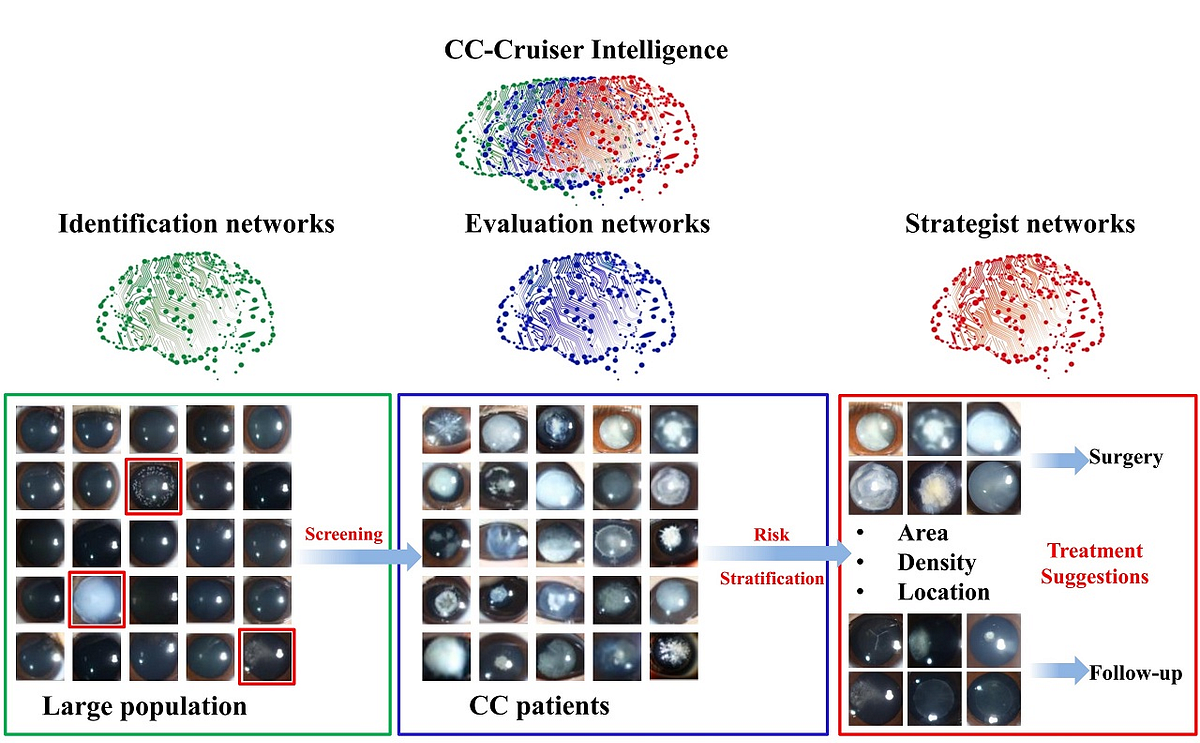 AI & Neural Network for Pediatric Cataract | by Susan Ruyu Qi | Health ...
