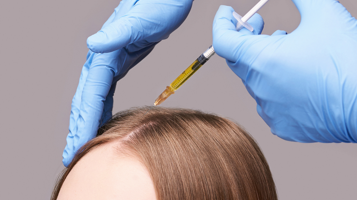 Is platelet-rich plasma (PRP) the key to reversing hair loss? | by ...